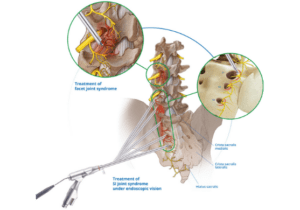 MultiZYTE® - joimax®