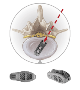 EndoLIF® - joimax®