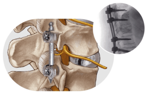 Percusys Plus® - joimax®