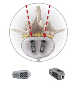 EndoLIF® - joimax®