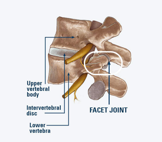 Facet Joint Syndrome - joimax®